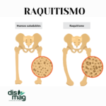 Raquitismo - Sales de Magnesio
