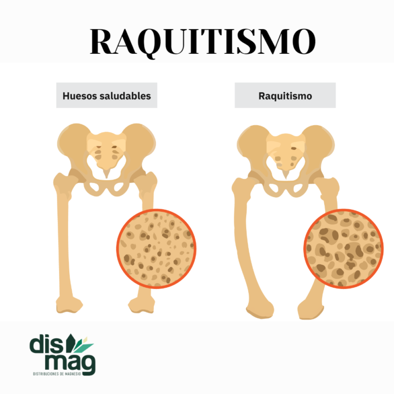 Raquitismo - Sales de Magnesio